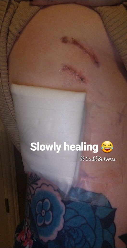 My Wonky Ribs and Neurectomy | IT COULD BE WORSE BLOG