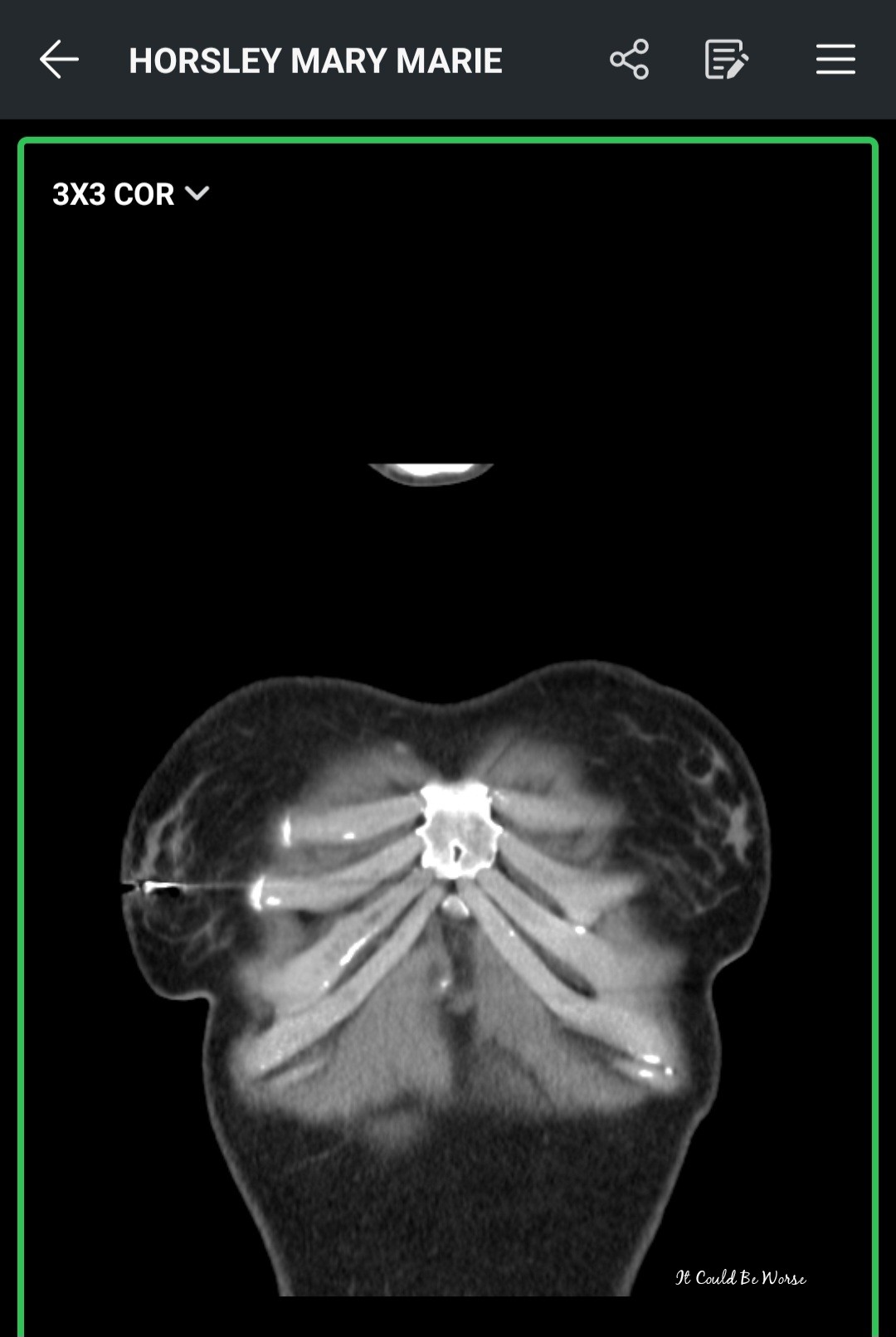 2023 Herniated Discs and Bridging Cartilage Fractures
